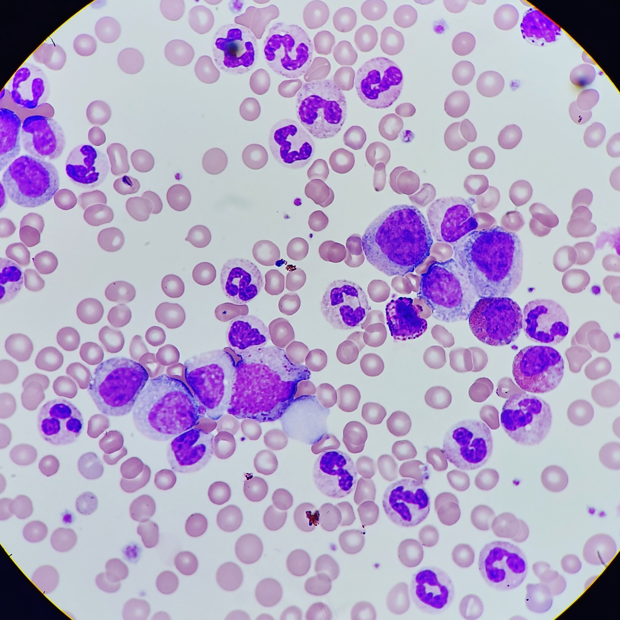 ANEMIAS NORMOCITICAS